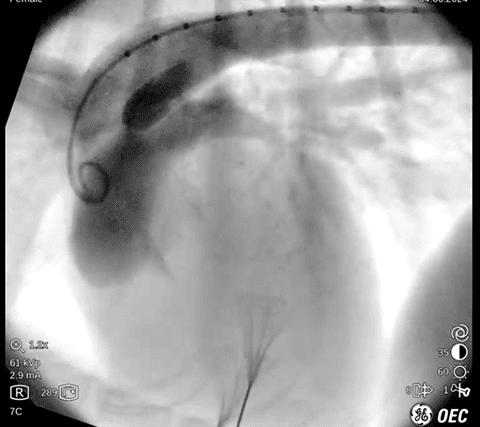 Closure of an atypical patent ductus arteriosus using an AVP-II plug ...